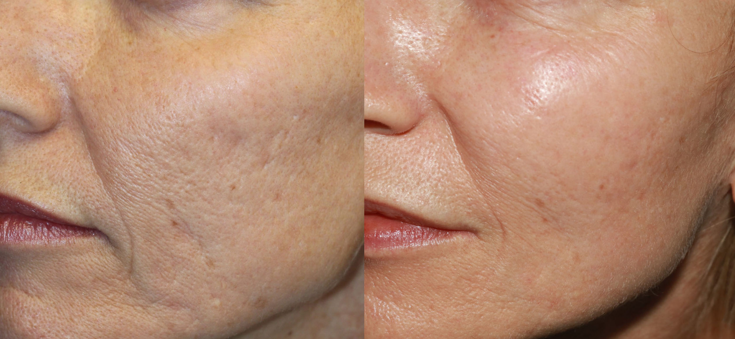 Microneedling - Mend Acupuncture