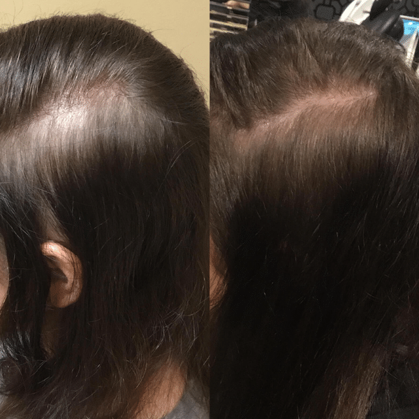 Microneedling - Mend Acupuncture